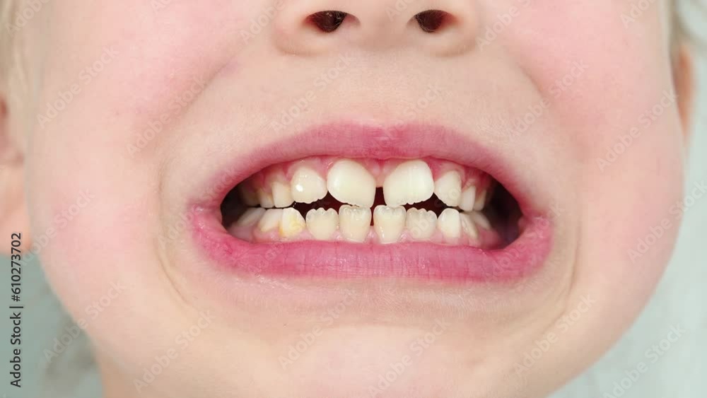 Children's molars crooked teeth large. Milk teeth. Malocclusion ...