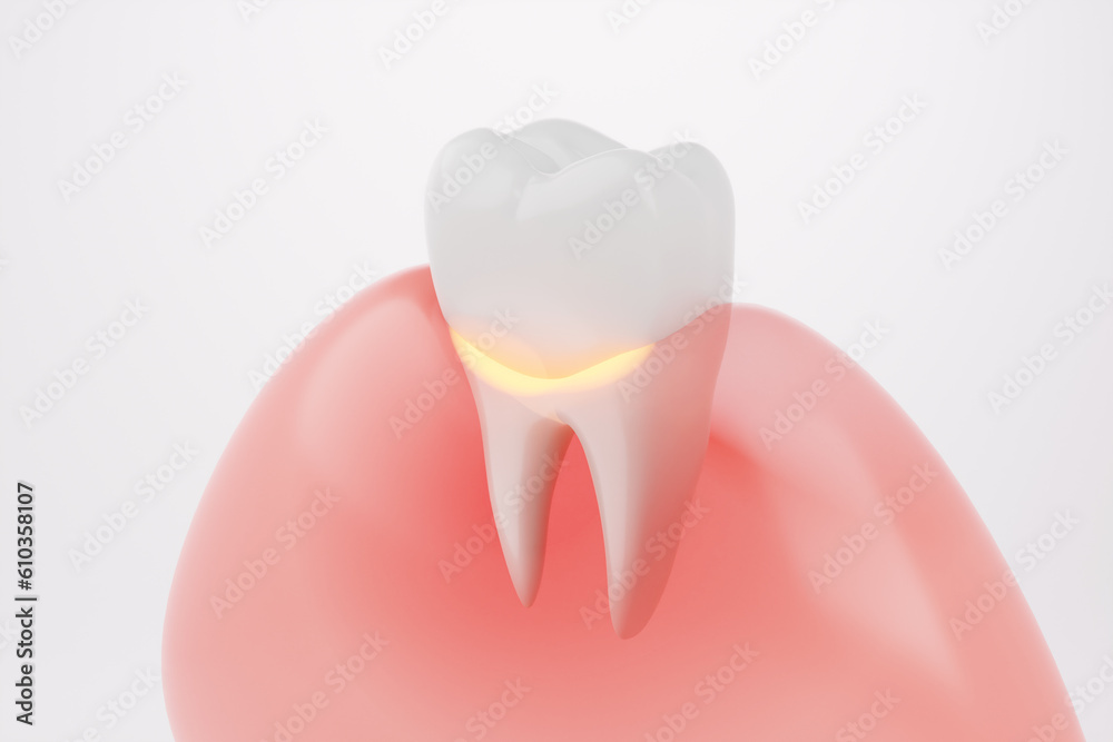 Gums gingivitis disease with teeth on white background. 3D rendering ...