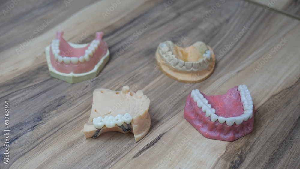 teeth produced in a dental laboratory. Dentures, implant teeth ...