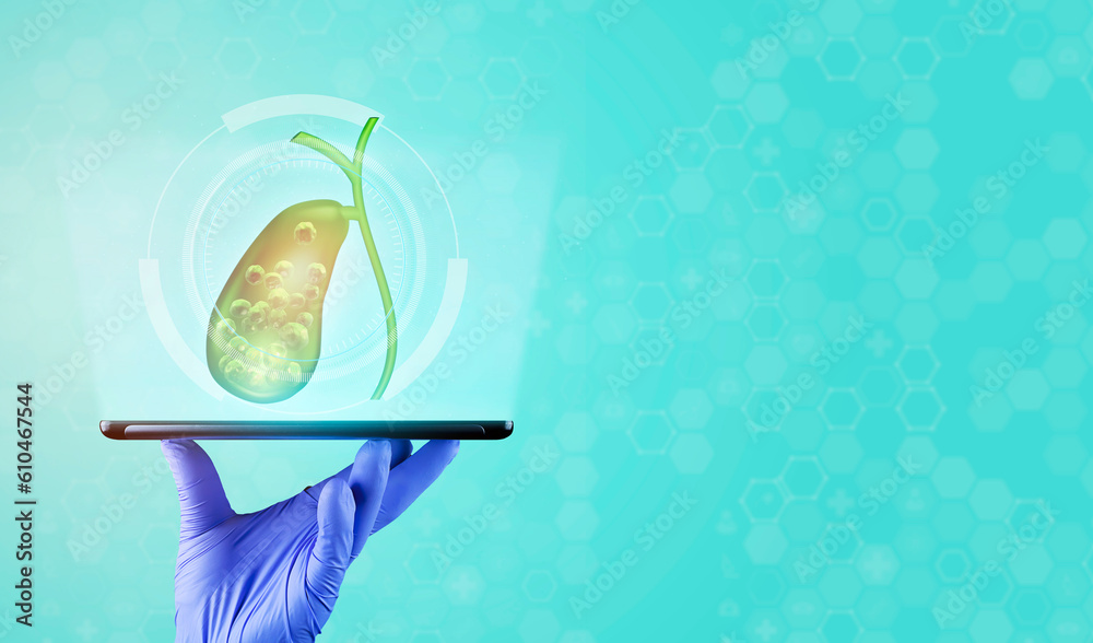 Gallbladder with stone. Care and treatment of gallstones, cholecystitis ...