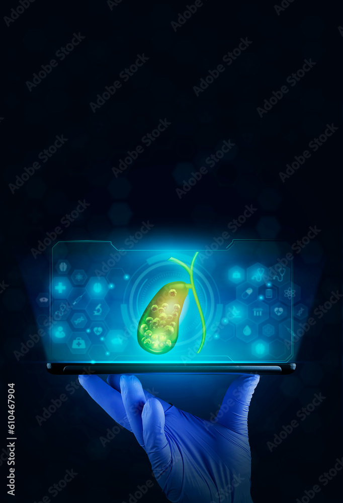 Gallbladder with stone. Care and treatment of gallstones, cholecystitis ...