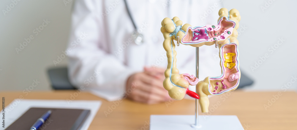 Doctor with human Colon anatomy model. Colonic disease, Large Intestine ...