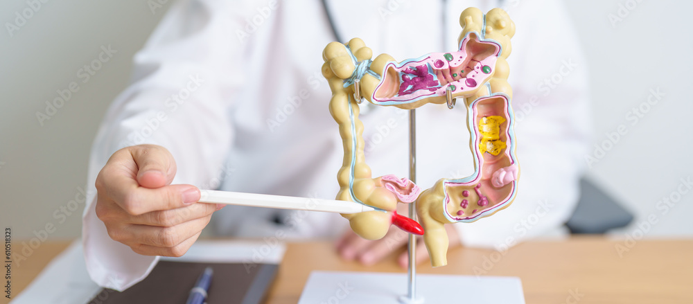 Doctor with human Colon anatomy model. Colonic disease, Large Intestine ...