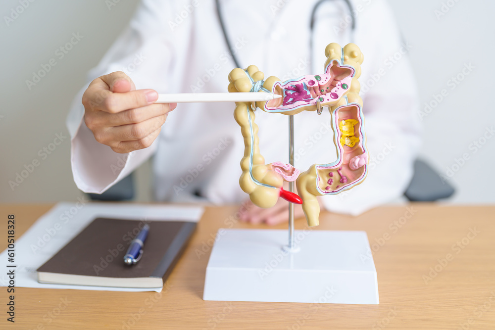 Doctor with human Colon anatomy model. Colonic disease, Large Intestine ...