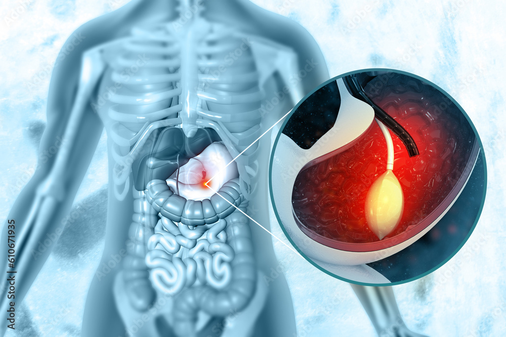 stomach Endoscopy. Gastric Ballon Inside a Stomach. 3d illustration ...