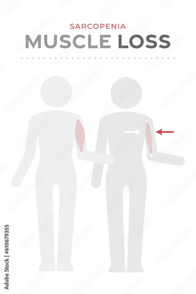 Fototapeta Sarcopenia, muscle loss icon. Human body pictogram with ... Fototapeta Sarcopenia, muscle loss icon. Human body pictogram with ...