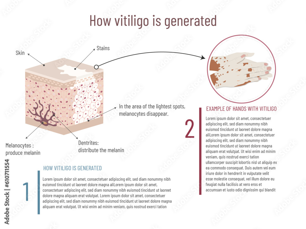 Infographic of the origin of vitiligo and visual example on the hands ...