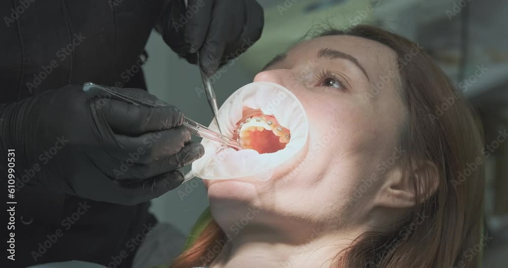 Orthodontist removes remnants of braces from patient's girl's mouth ...
