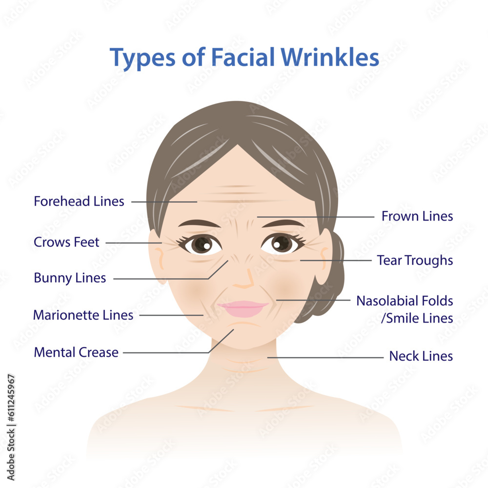 Types of facial wrinkles vector illustration isolated on white ...