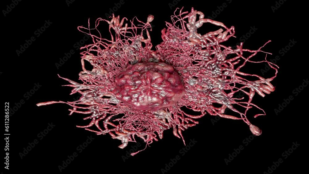 Cancer cell growth uncontrollably over tissue, Tumor infection cells ...