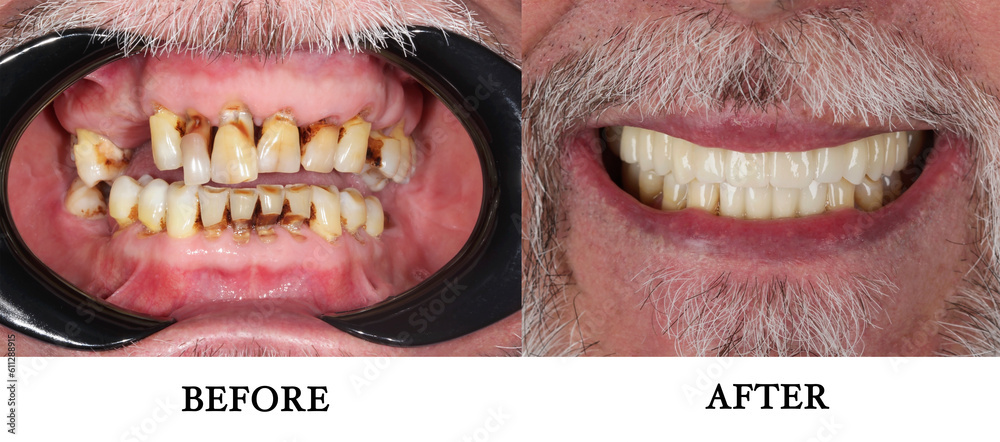 Comparative collage Before and After. Installation of veneers. Chronic ...