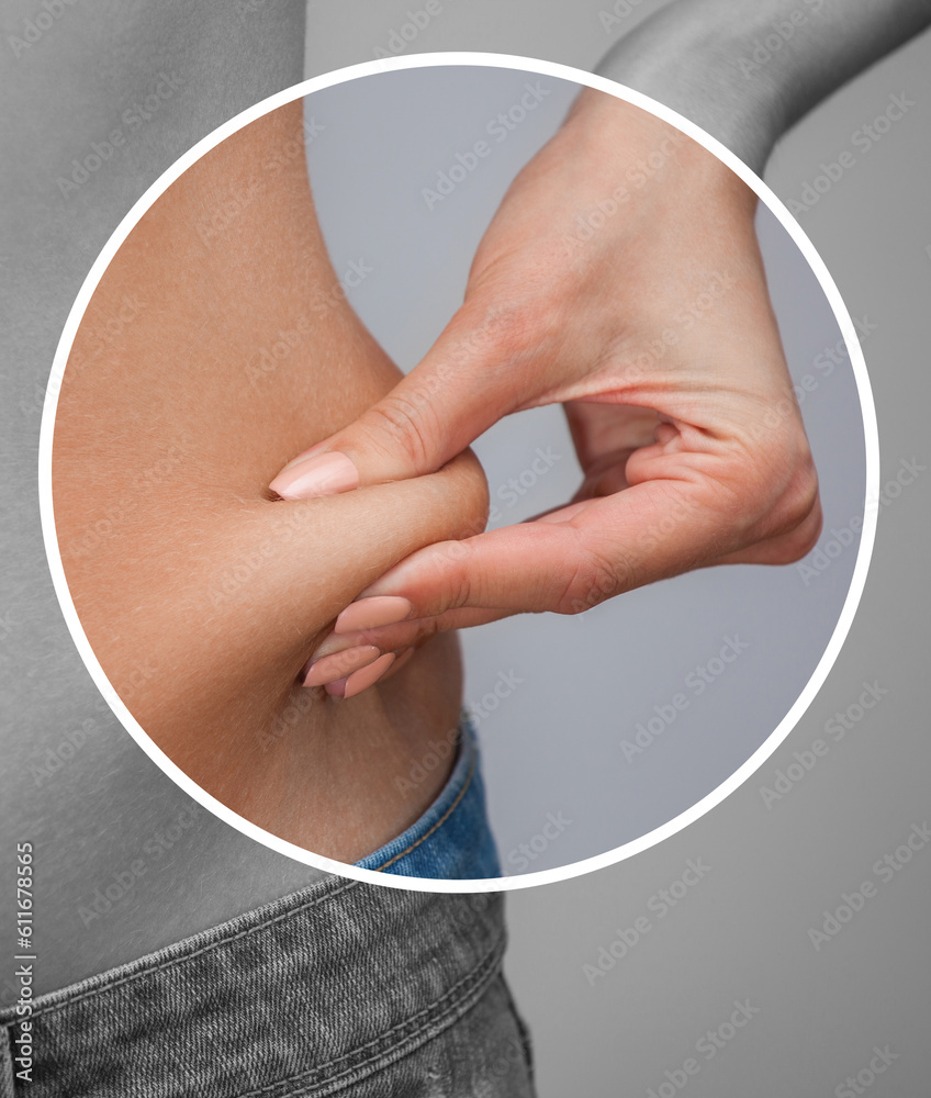 Girl pulls the skin on the abdomen, showing the body fat. Treatment and ...