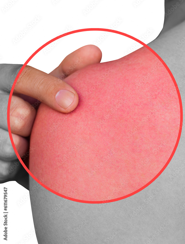 A man with reddened itchy skin after sunburn, smears cream on the skin ...