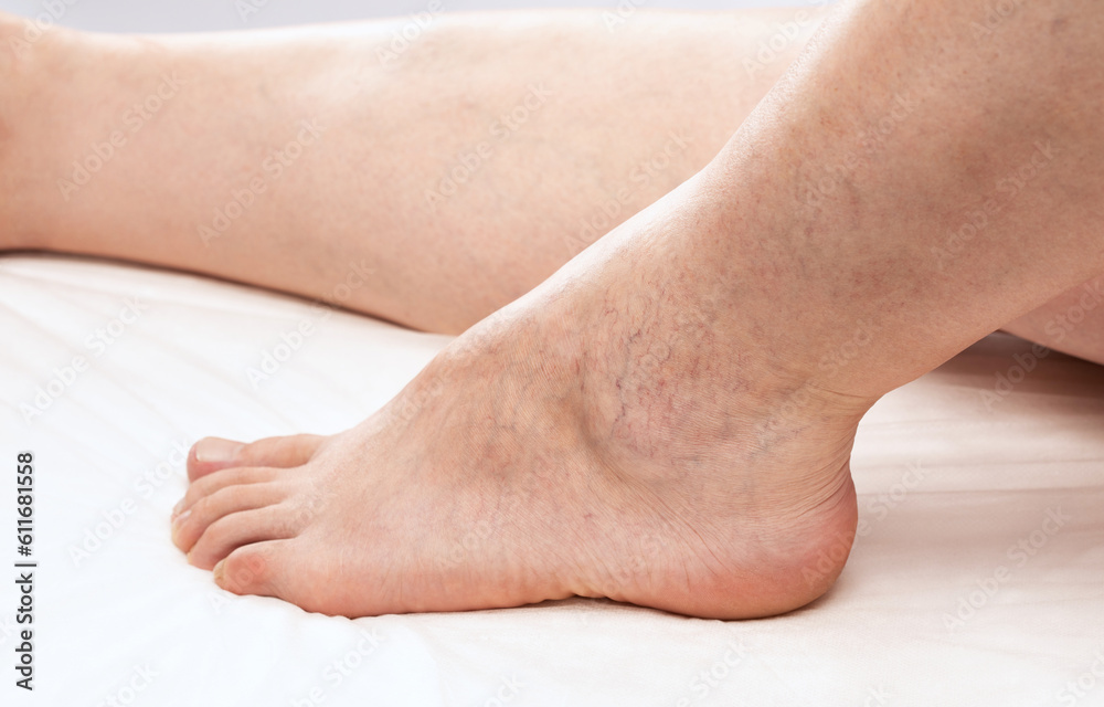 Foto de doctor shows the dilation of small blood vessels of the skin on ...