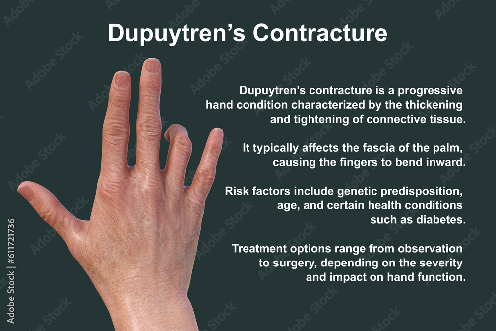 Hand of a patient with Dupuytren's contracture, photorealistic 3D ...