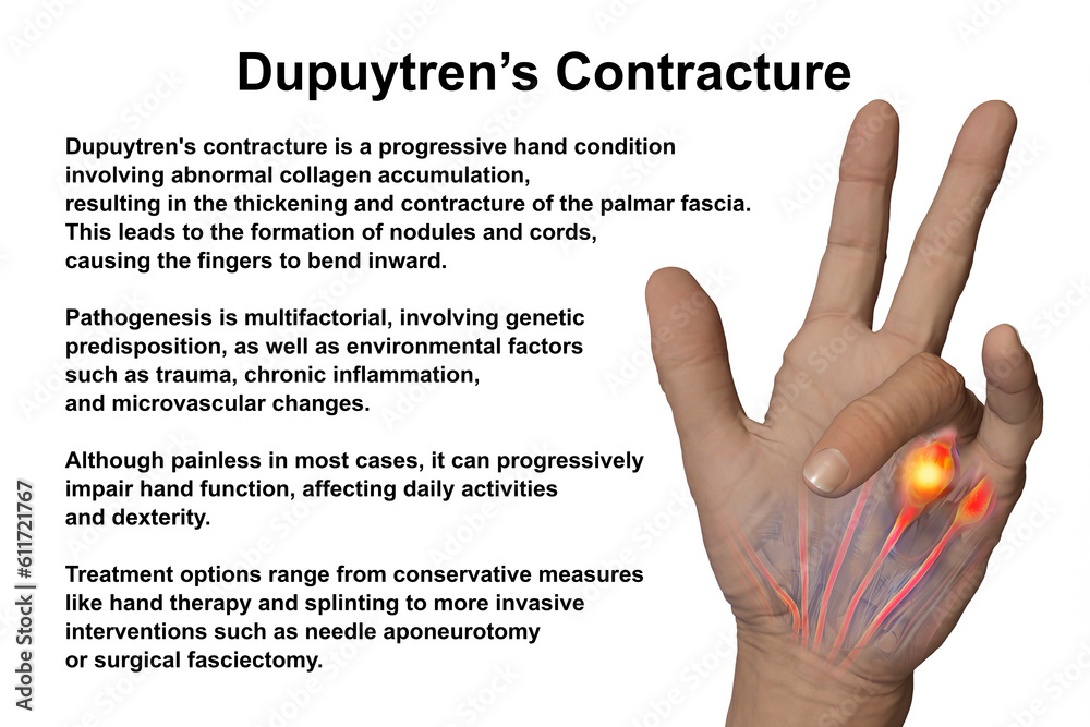 A 3D medical illustration displaying a patient's hand with Dupuytren's ...