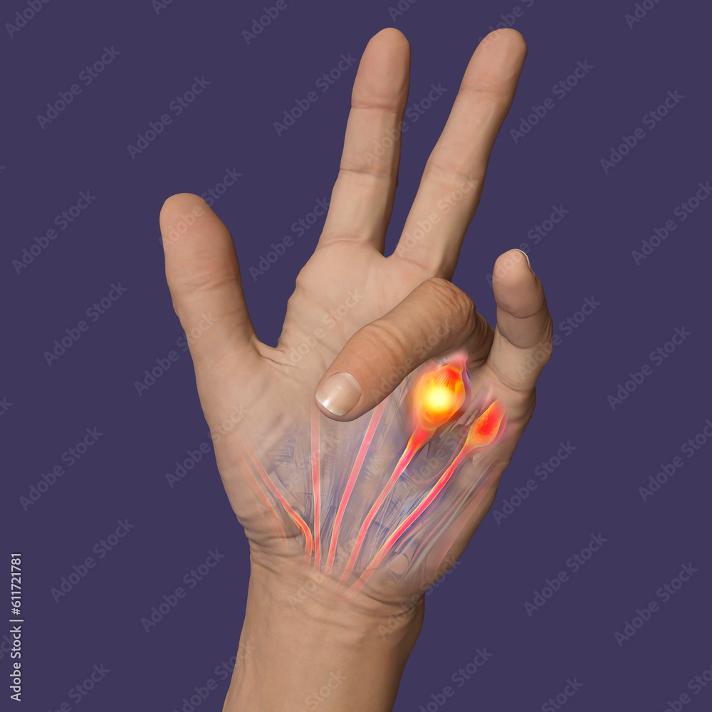 A 3D medical illustration displaying a patient's hand with Dupuytren's ...