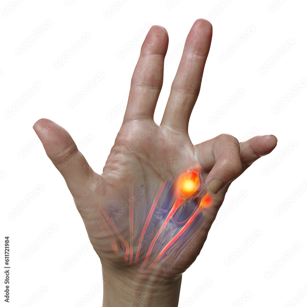 A 3D medical illustration displaying a patient's hand with Dupuytren's ...