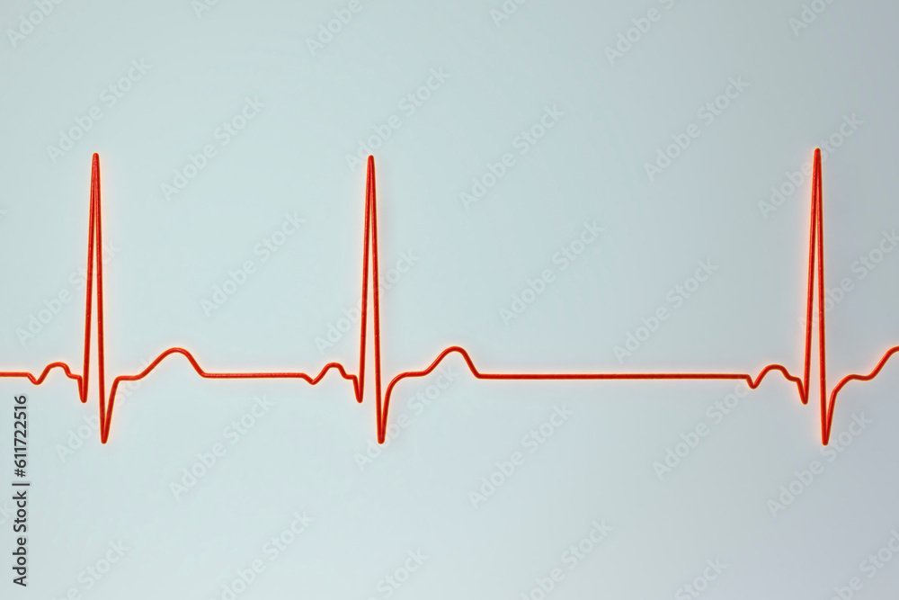 Electrocardiogram ECG displaying sinus arrhythmia, 3D illustration ...