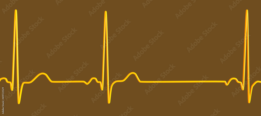 Electrocardiogram ECG displaying sinus arrhythmia, 3D illustration ...