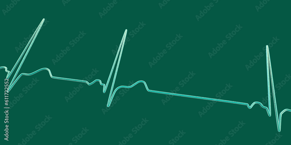 Electrocardiogram ECG displaying sinus arrhythmia, 3D illustration ...