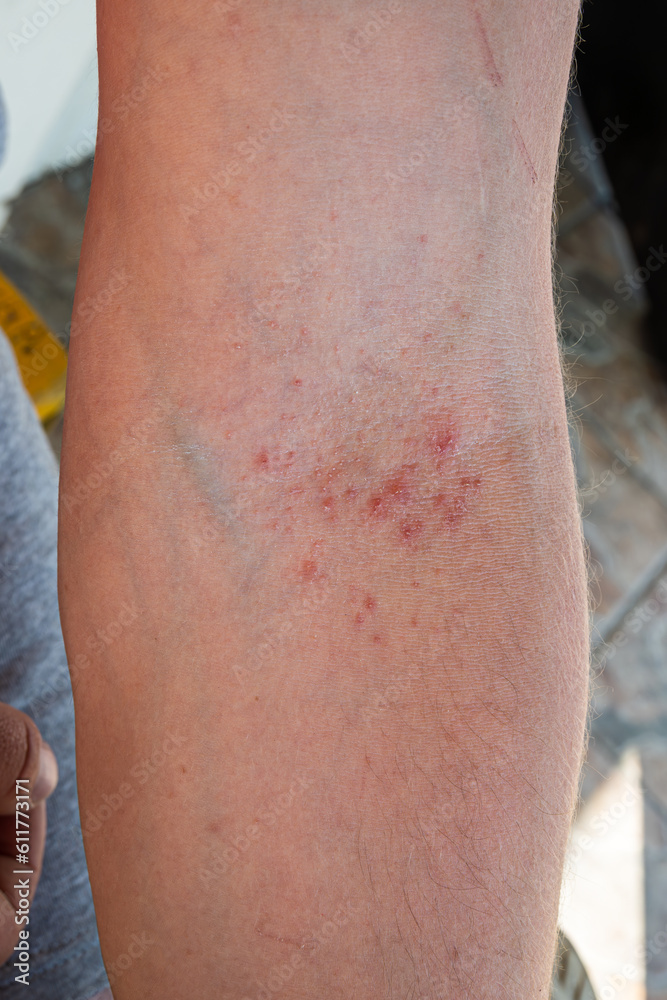 Red rash on the skin of the hand close-up Stock Photo | Adobe Stock