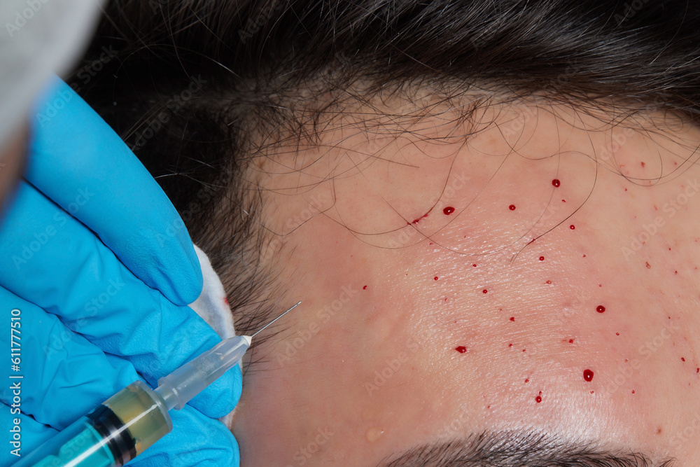 Injection at spa salon. Doctor hands in gloves. Closeup. Pretty male ...