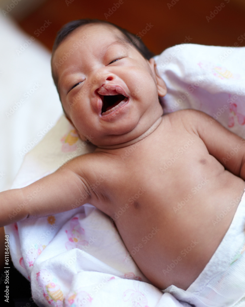 Cleft lip, baby and child birth with a portrait of a newborn crying in ...