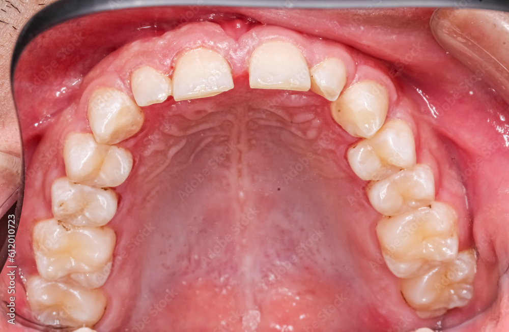 Dentistry case of upper maxillary arch, indirect occlusal view with ...