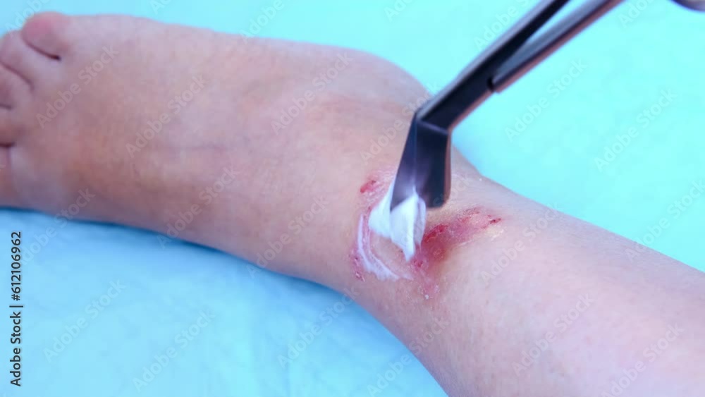 close-up of human shin, doctor treats numerous wounds on leg of adult ...