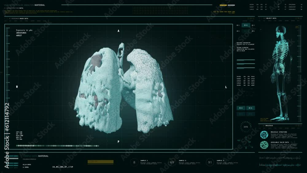 Lung Cancer Detected By Innovative Ct Scanner Software Interface ...