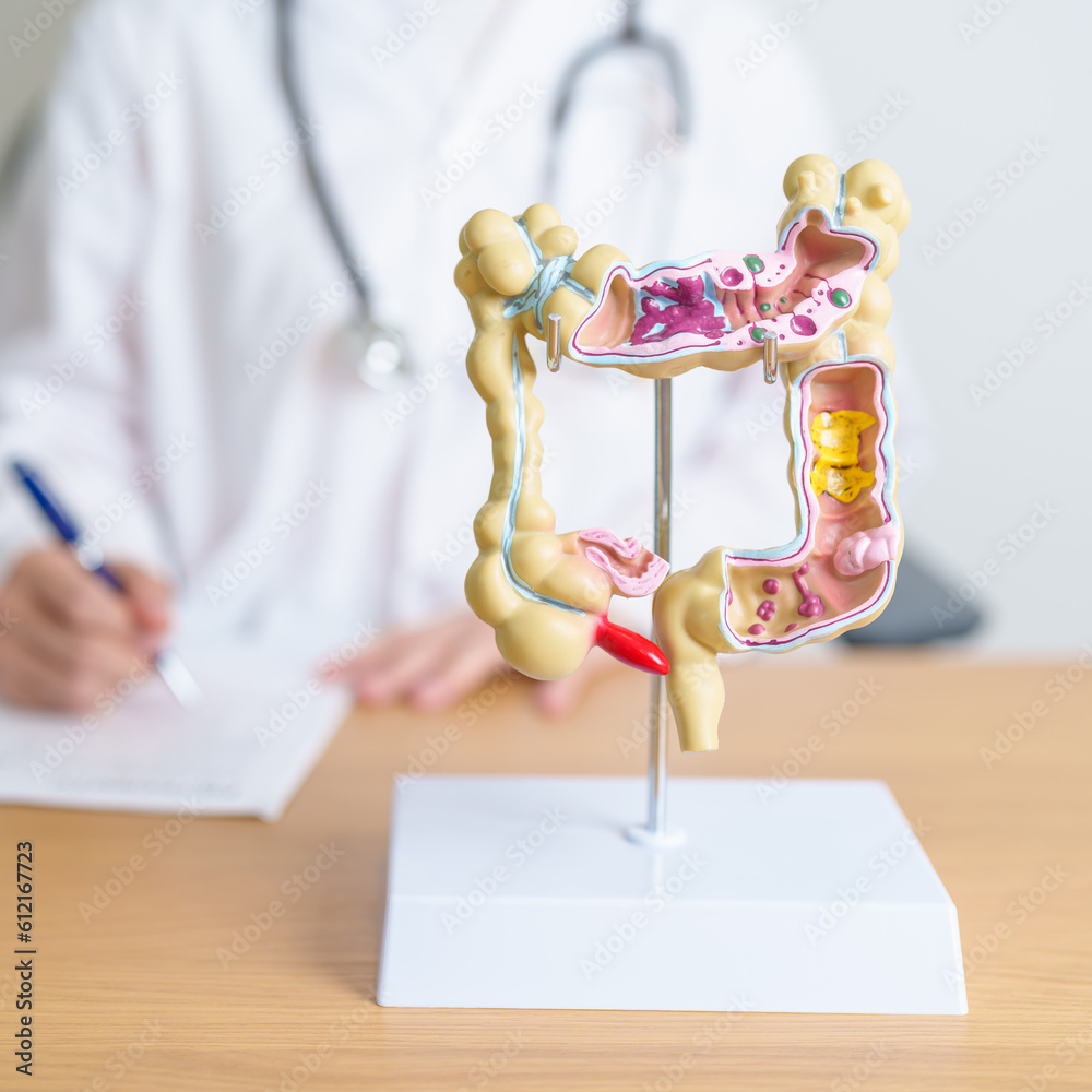 Doctor with human Colon anatomy model. Colonic disease, Large Intestine ...