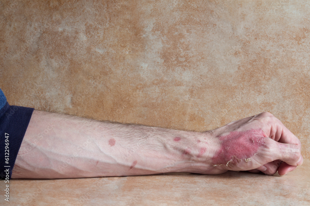 An arm o an abstract background with a second-degree burn on the hand ...