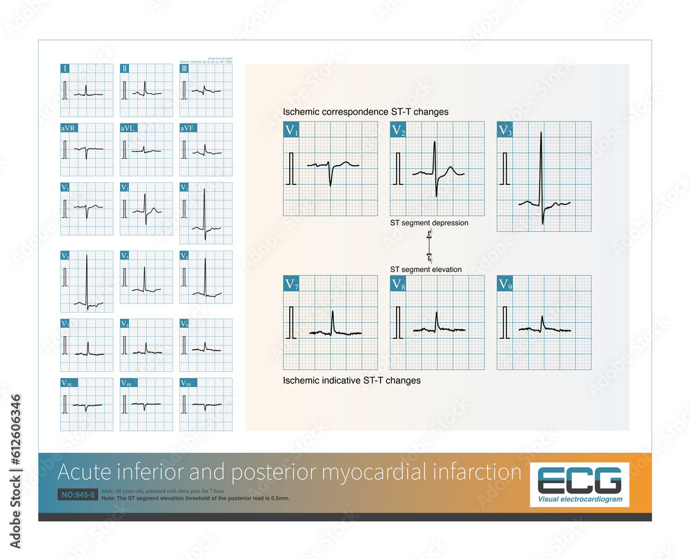 Male, 68 years old, chest pain for 7 hours. Coronary angiography ...