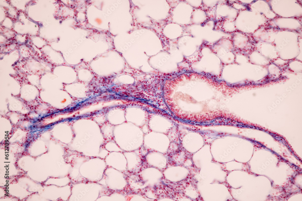 Human lung pathology under light microscope, The lungs is organs of the ...