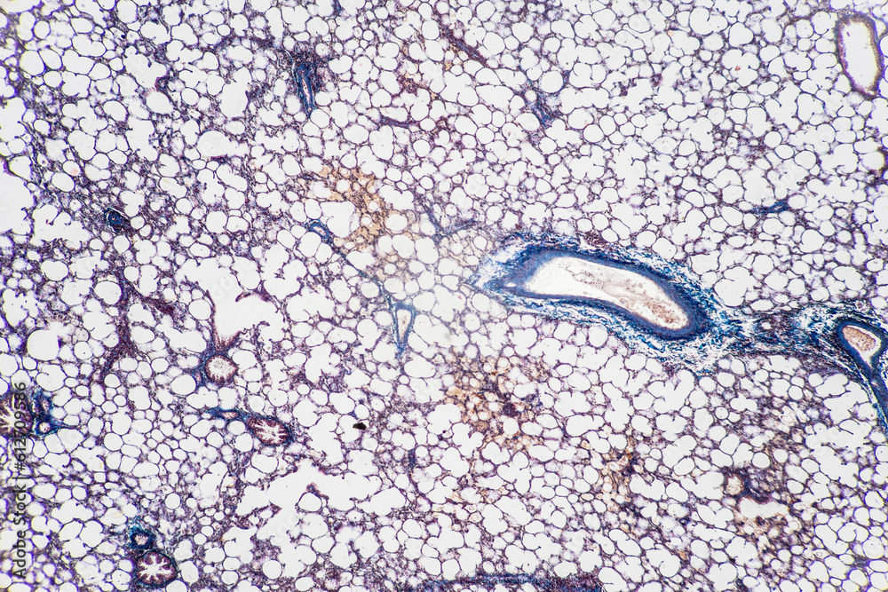 Human lung pathology under light microscope, The lungs is organs of the ...