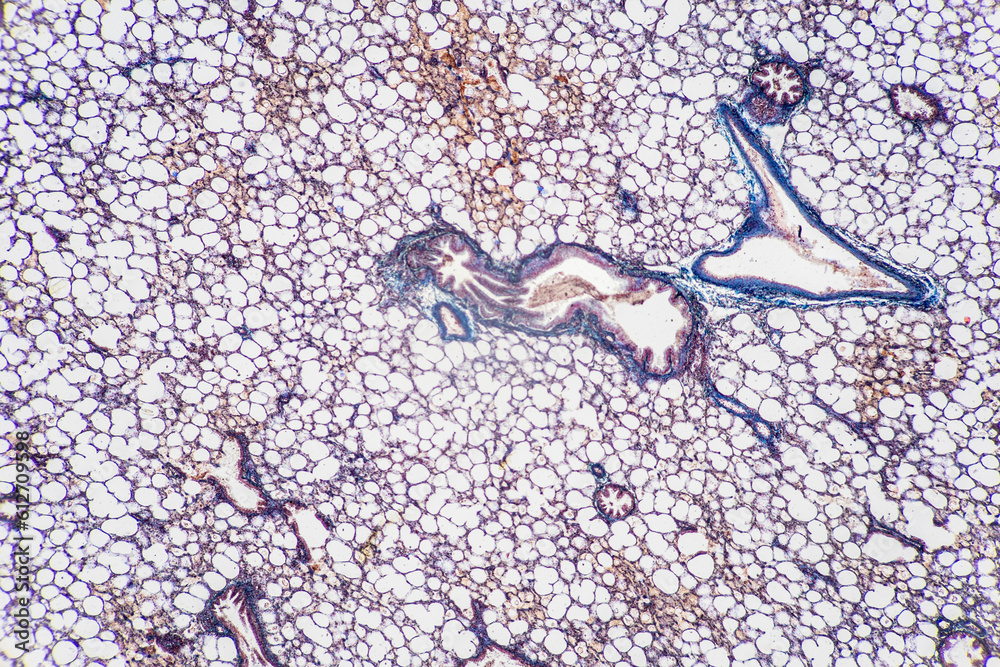 Human lung pathology under light microscope, The lungs is organs of the ...