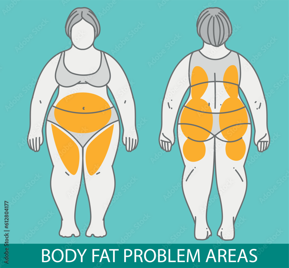 Body fat problem areas. Medical infographic. Healthcare illustration ...