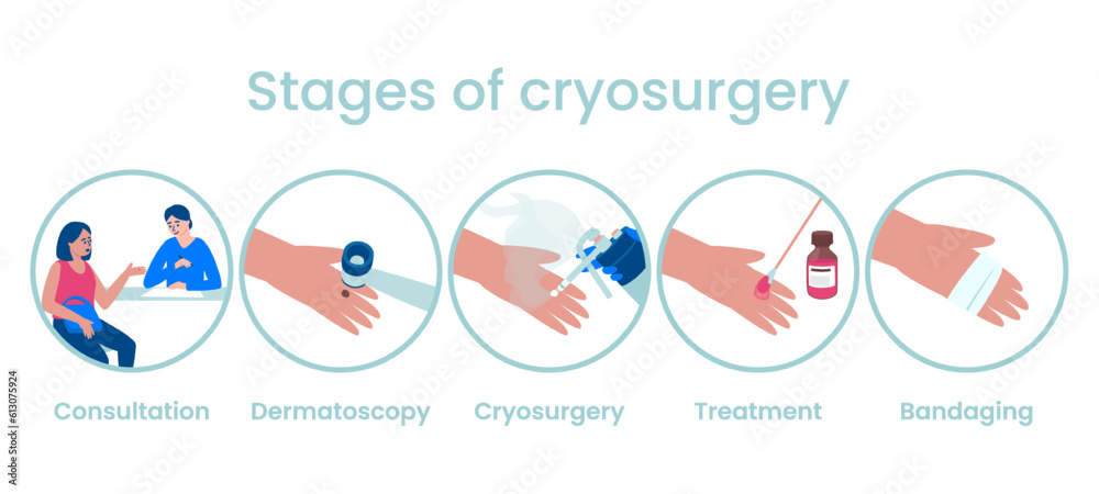 Stages of the cryosurgery procedure in the treatment of skin neoplasms ...