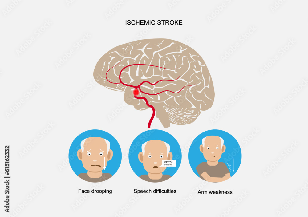 Ischemic stroke and warning signs and symptoms Stock Vector | Adobe Stock