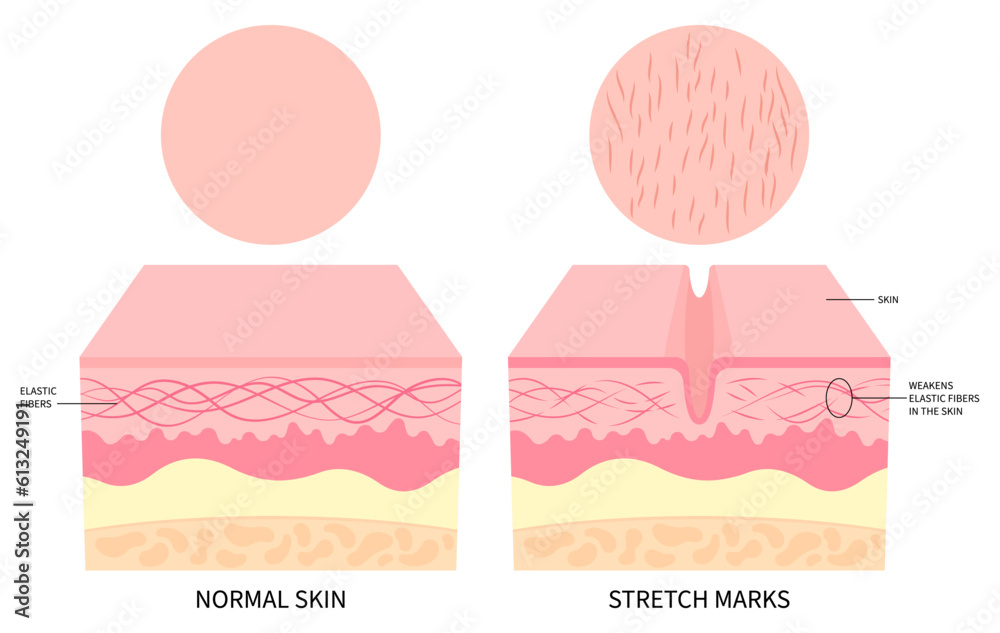 Medical anatomy of skin and stretch marks and gain loss muscle the ...