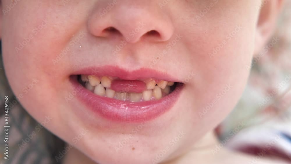 Close-up of a child's mouth without two upper deciduous teeth ...