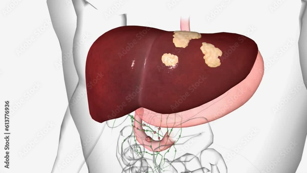 Duodenal carcinoma, also known as small intestine adenocarcinoma, is a ...