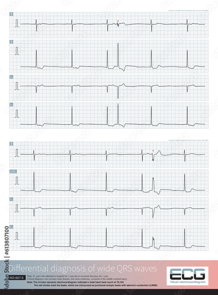 An 81-year-old man with a clinical diagnosis of coronary heart disease ...