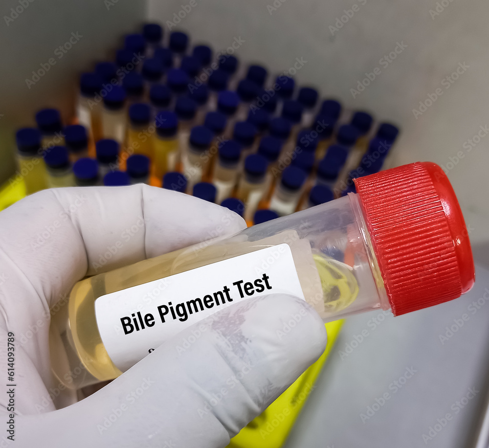Urinary bile pigment test with laboratory tube background. Urine ...