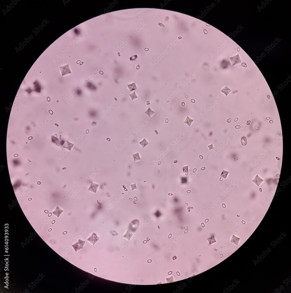 UTI. Budding yeast cells and calcium oxalate crystal in urine, urinary ...
