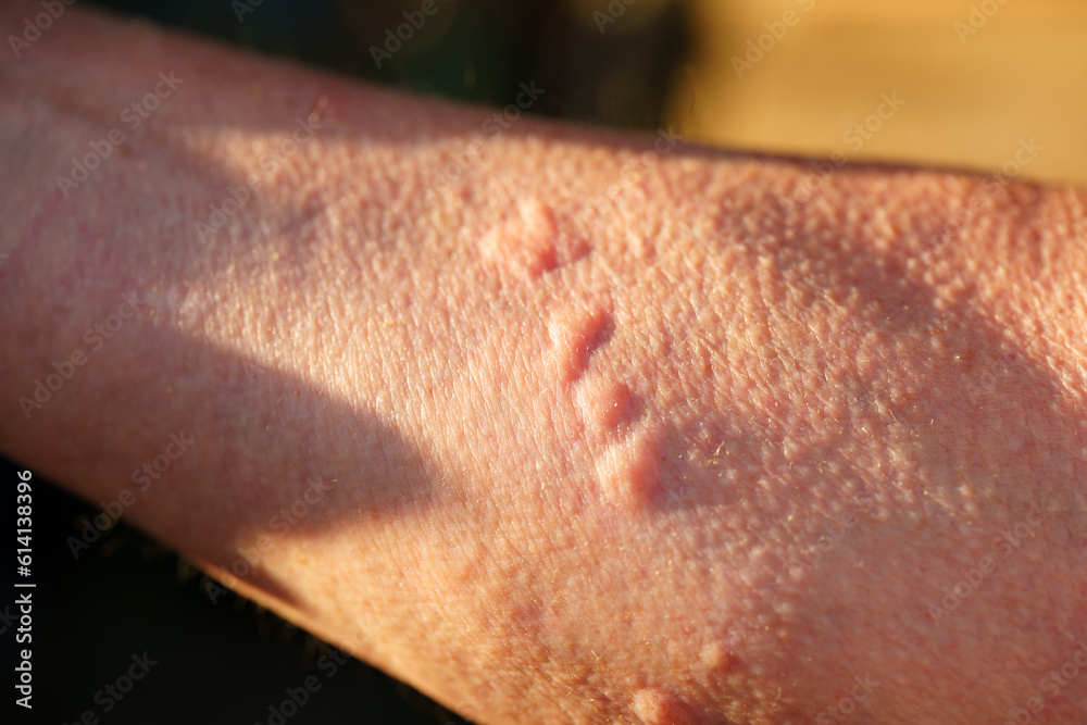 The skin's reaction to nettle is urticaria. Red, severely itchy rashes ...