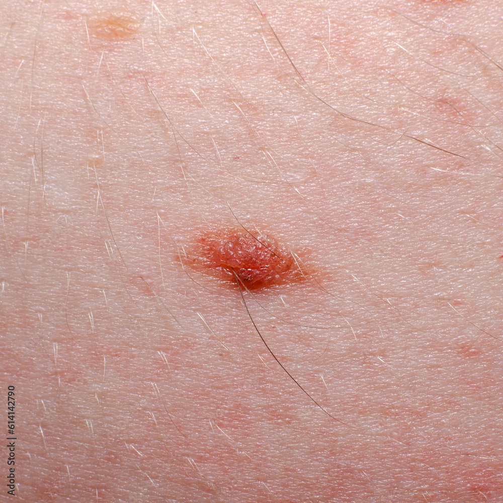 Nevus or mole on the human body close-up. Skin cancer, keratosis or ...