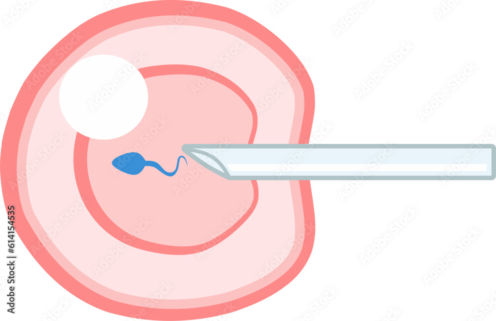 IVF ICSI vector illustration. Perfect for presenting anything about ...