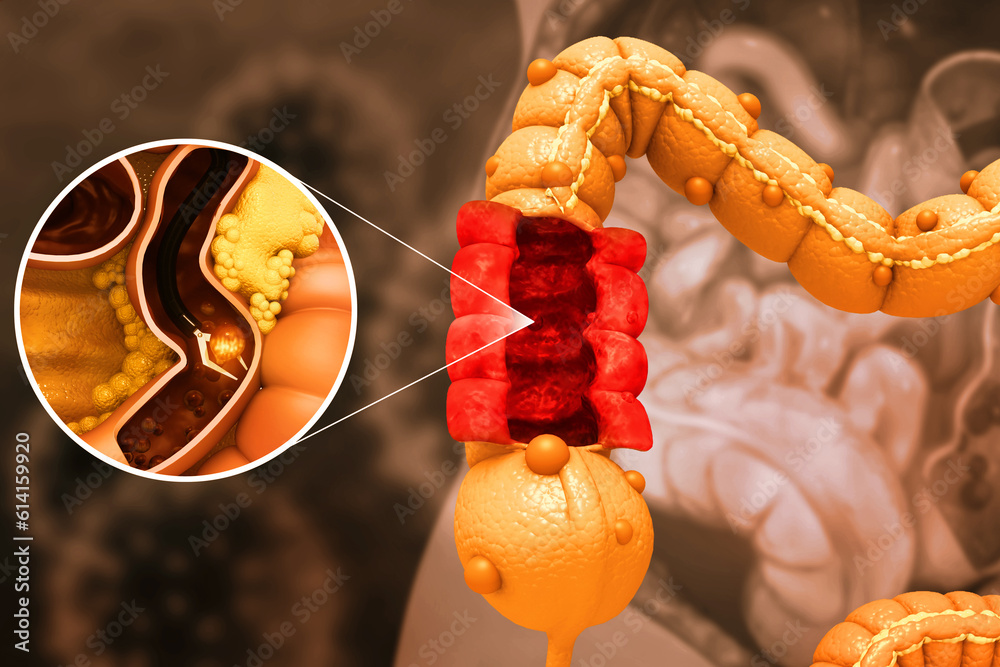 Colon Cancer Colon Polyp Removal Endoscope Inside Colonoscopy For Colon Polyps Search 3d